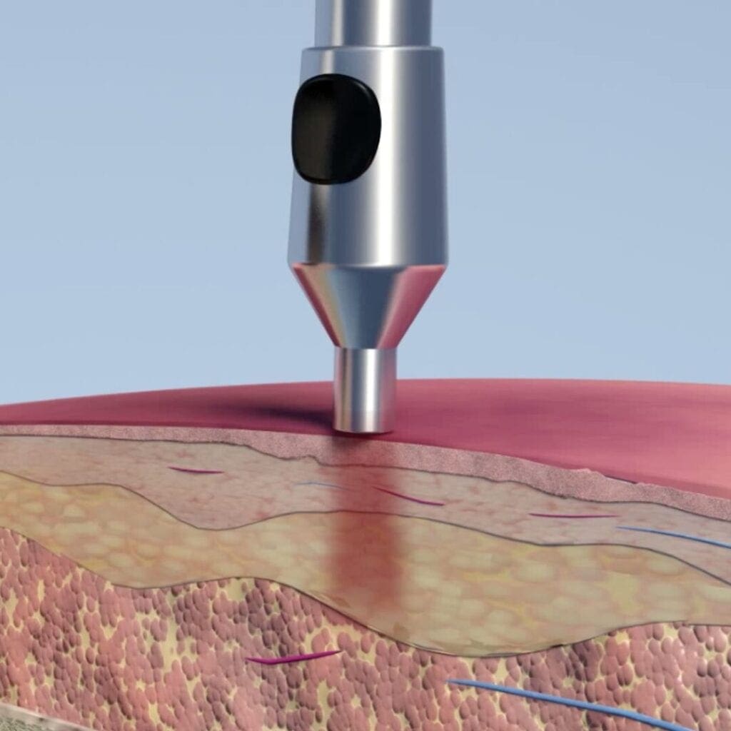 Laser Therapy Medical Treatment Class IV | LightForce Therapy Lasers